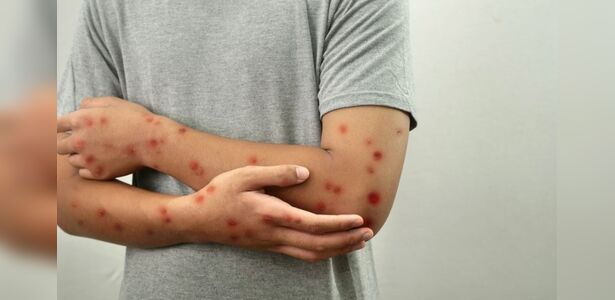 Segundo caso de nova cepa de 'mpox' é confirmado no Estado de São Paulo ...