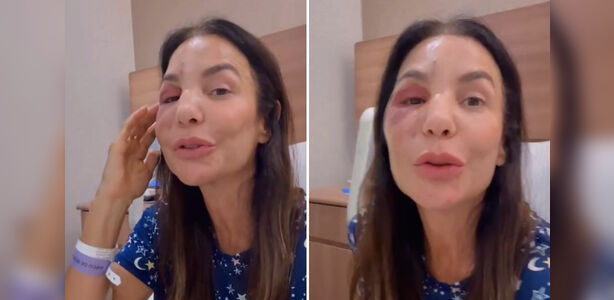 Ivete Sangalo ressurge após cirurgia no rosto: 'Poderia ter sido tão pior'